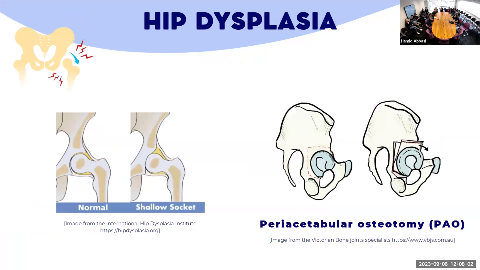 Slide 7/41 at 05:24: HIP DYSPLASIA